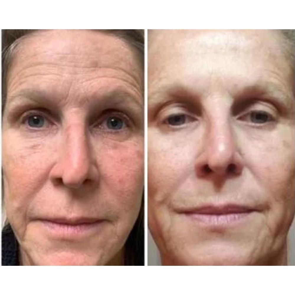 GLOWTOX Facial - “Glass Skin” Botox Facial - Snatch and Glow London