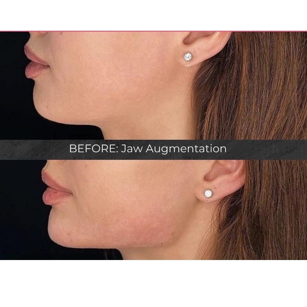 Jawline Filler Treatment - London - Snatch and Glow London
