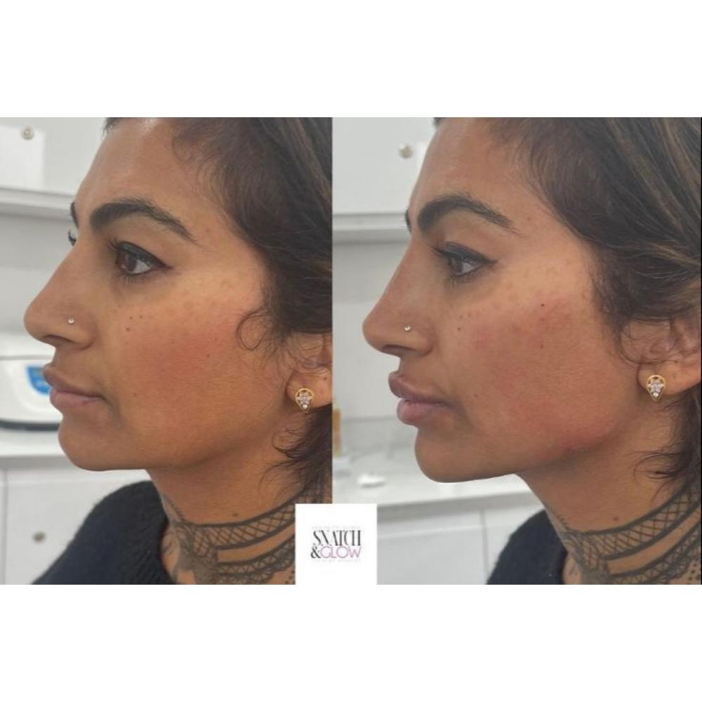 Liquid Rhinoplasty / Pixie Nose Lift / Nose Filler - Snatch and Glow London