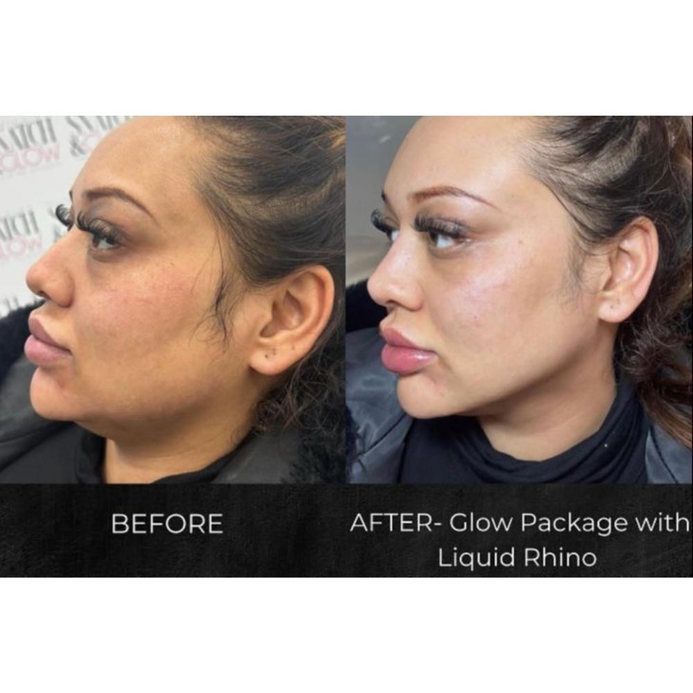 The Glow Package - Includes Under Eye And Lips - Snatch and Glow London