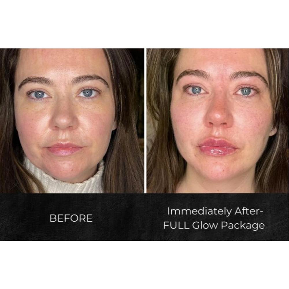 The Glow Package - Includes Under Eye And Lips - Snatch and Glow London